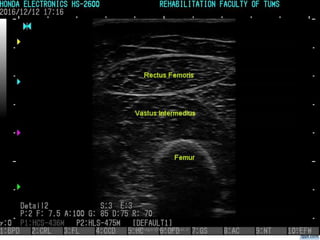 Echogenicity: Implication of Rehabilitative Ultrasound Imaging for ...