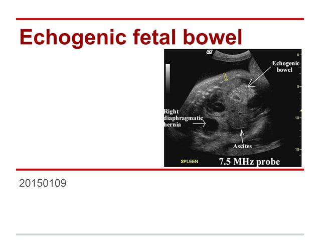 Echogenic fetal bowel | PDF