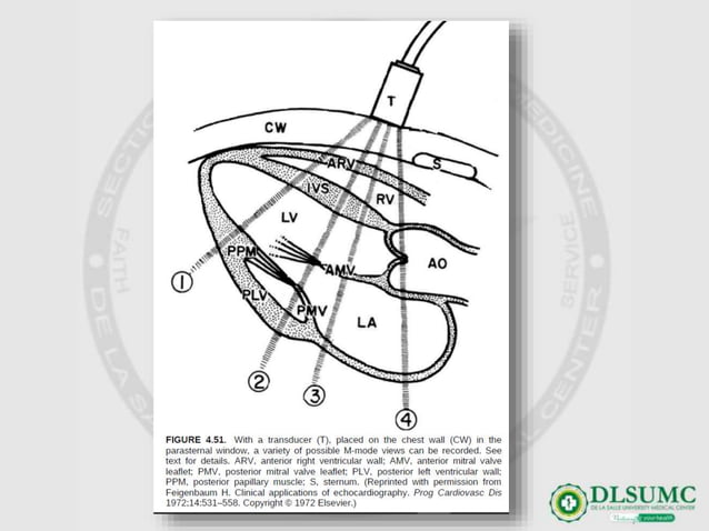 Echo Hour M-Mode and LV systolic Function.pptx | Heart and Cardiovascular Diseases | Diseases ...