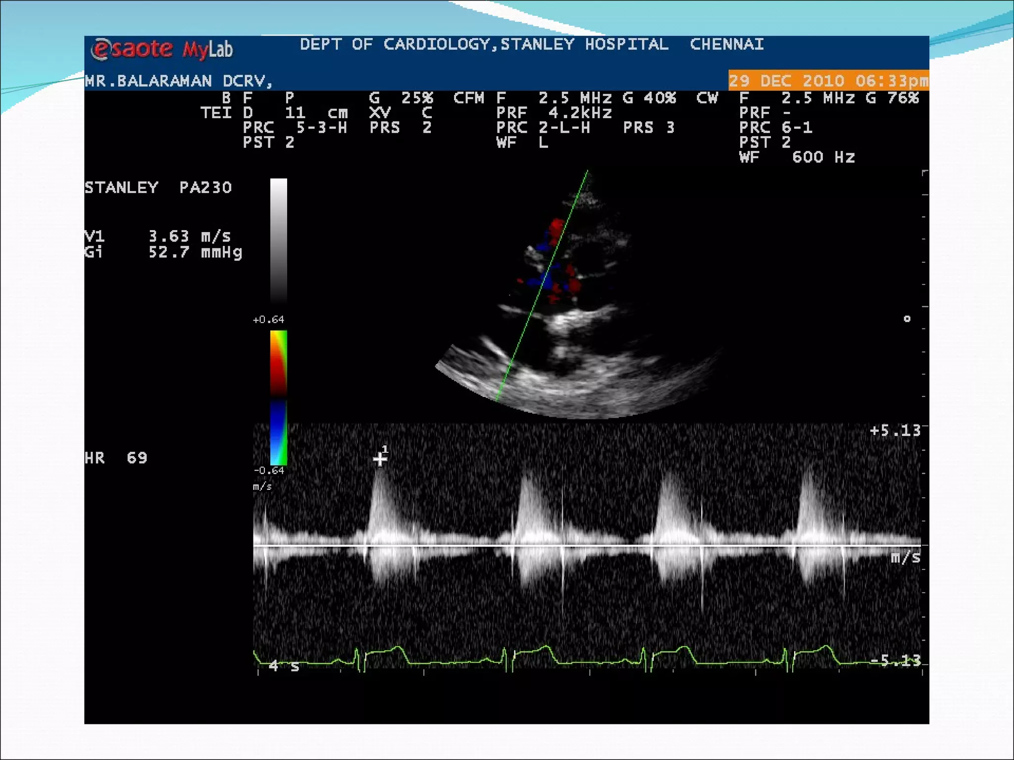 Echocardiogram with basics | PPT