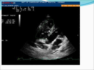 Echocardiogram with basics | PPT