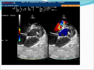 Echocardiogram with basics | PPT