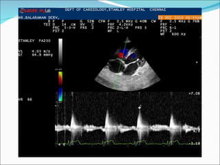 Echocardiogram with basics | PPT