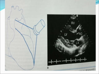 Echocardiogram with basics | PPT