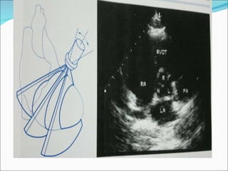 Echocardiogram with basics | PPT