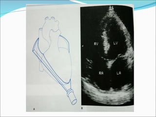 Echocardiogram with basics | PPT