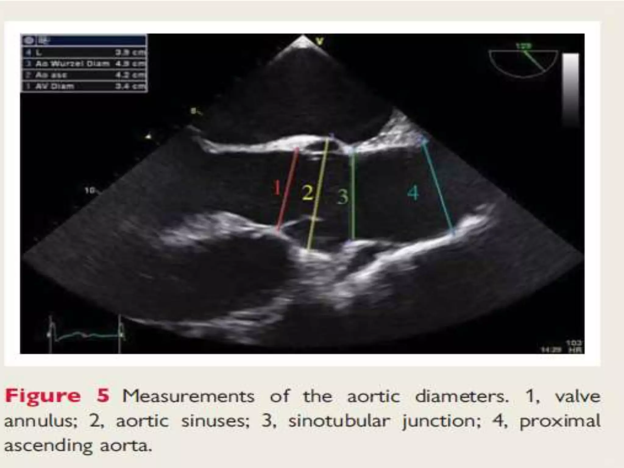 ECHOCARDIOGRAM IN AORTIC REGURGITATION (AR) | PPTX