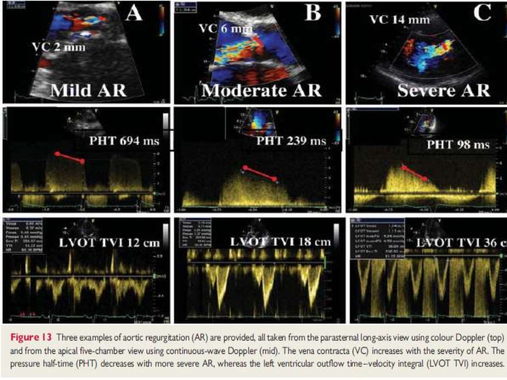 ECHOCARDIOGRAM IN AORTIC REGURGITATION (AR)