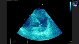 Echo in Cardiac Arrest | PPT