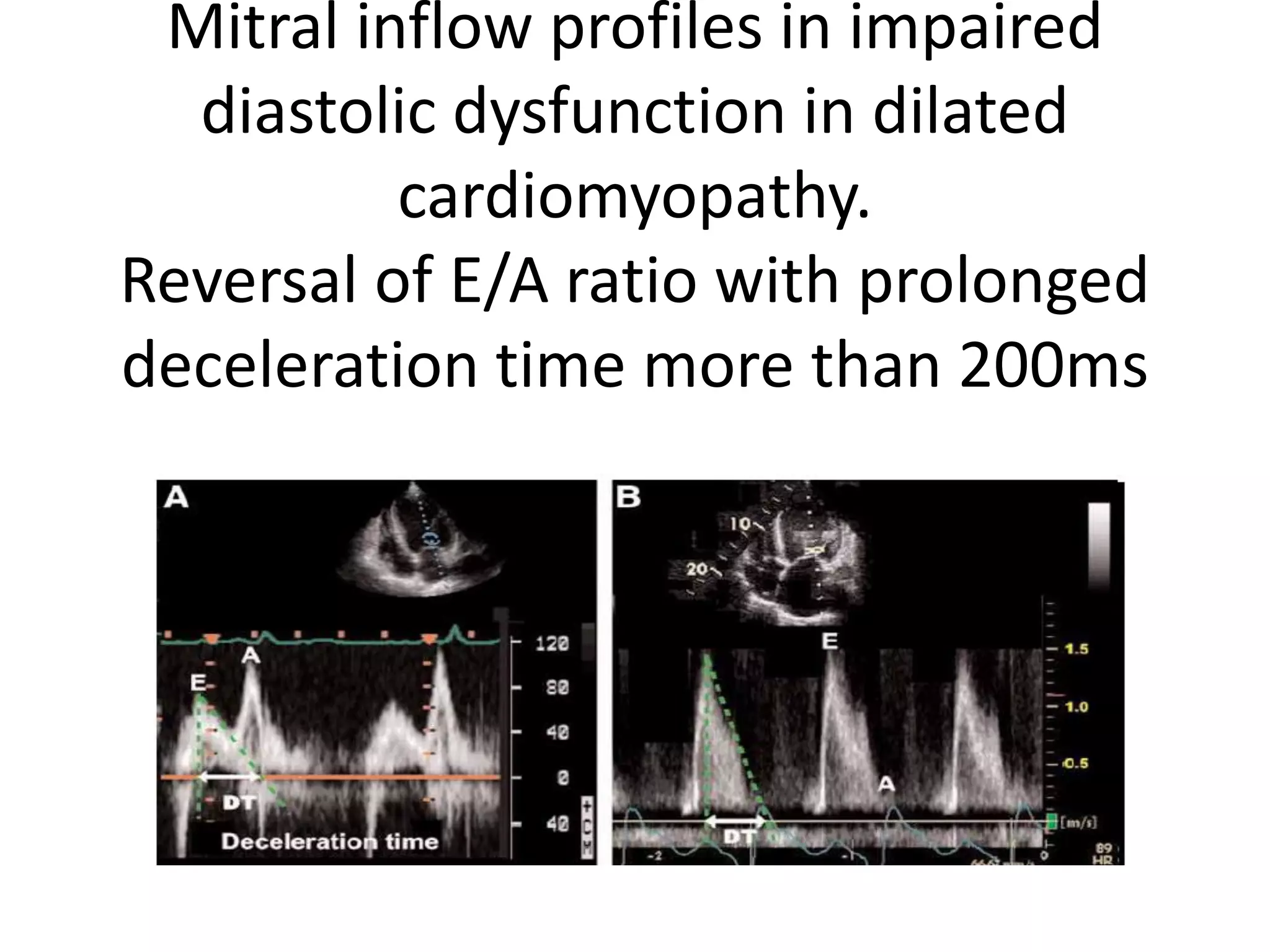 Echo in cardiomyopathies part 1 | PDF