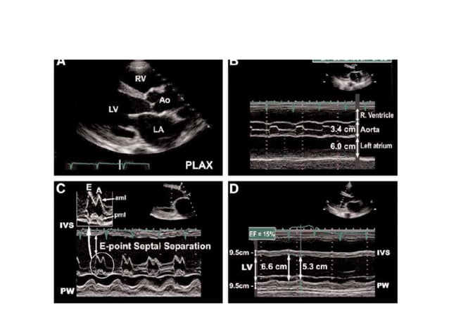 Echo in cardiomyopathies part 1 | PDF | Heart and Cardiovascular ...