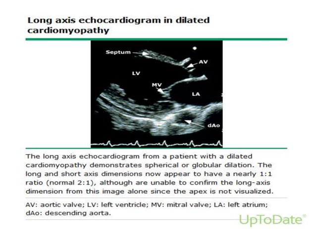 Echo in cardiomyopathies part 1 | PDF | Heart and Cardiovascular ...