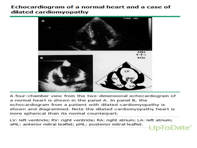 Echo in cardiomyopathies part 1 | PDF | Heart and Cardiovascular ...
