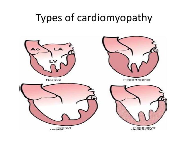 Echo in cardiomyopathies part 1 | PDF | Heart and Cardiovascular ...