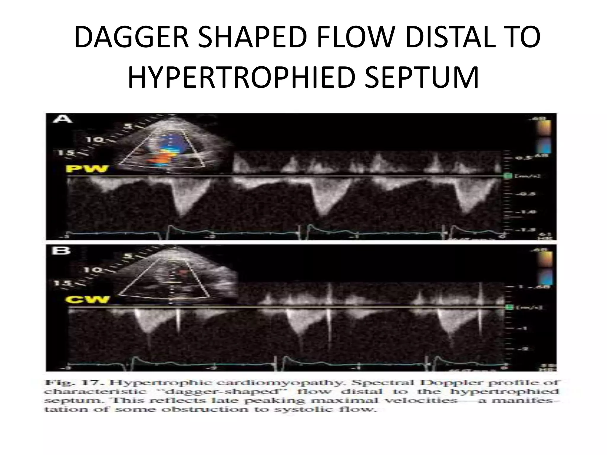 Echo in hypertrophic obstructive cardiomyopathies | PPTX