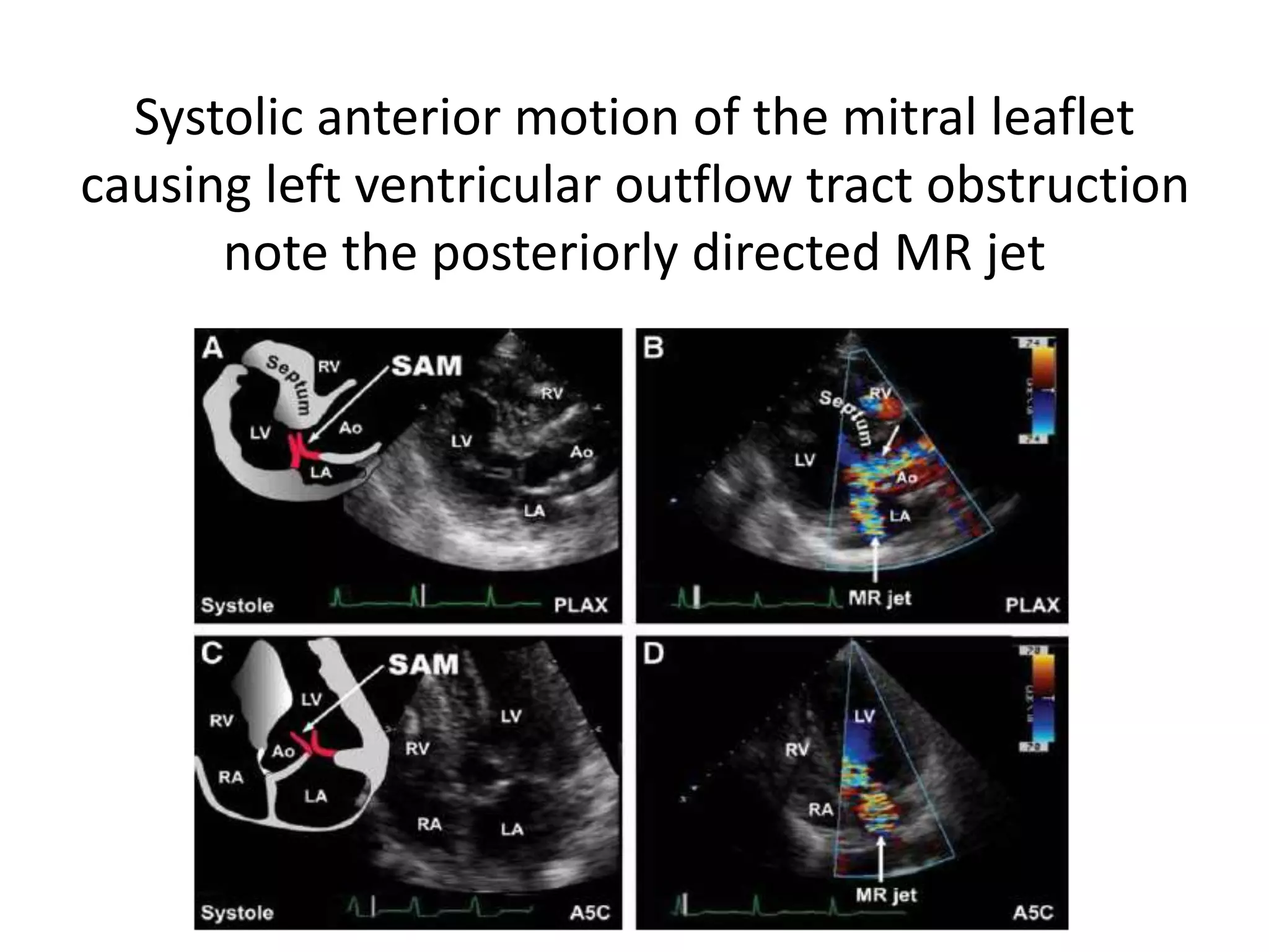 Echo in hypertrophic obstructive cardiomyopathies | PPTX