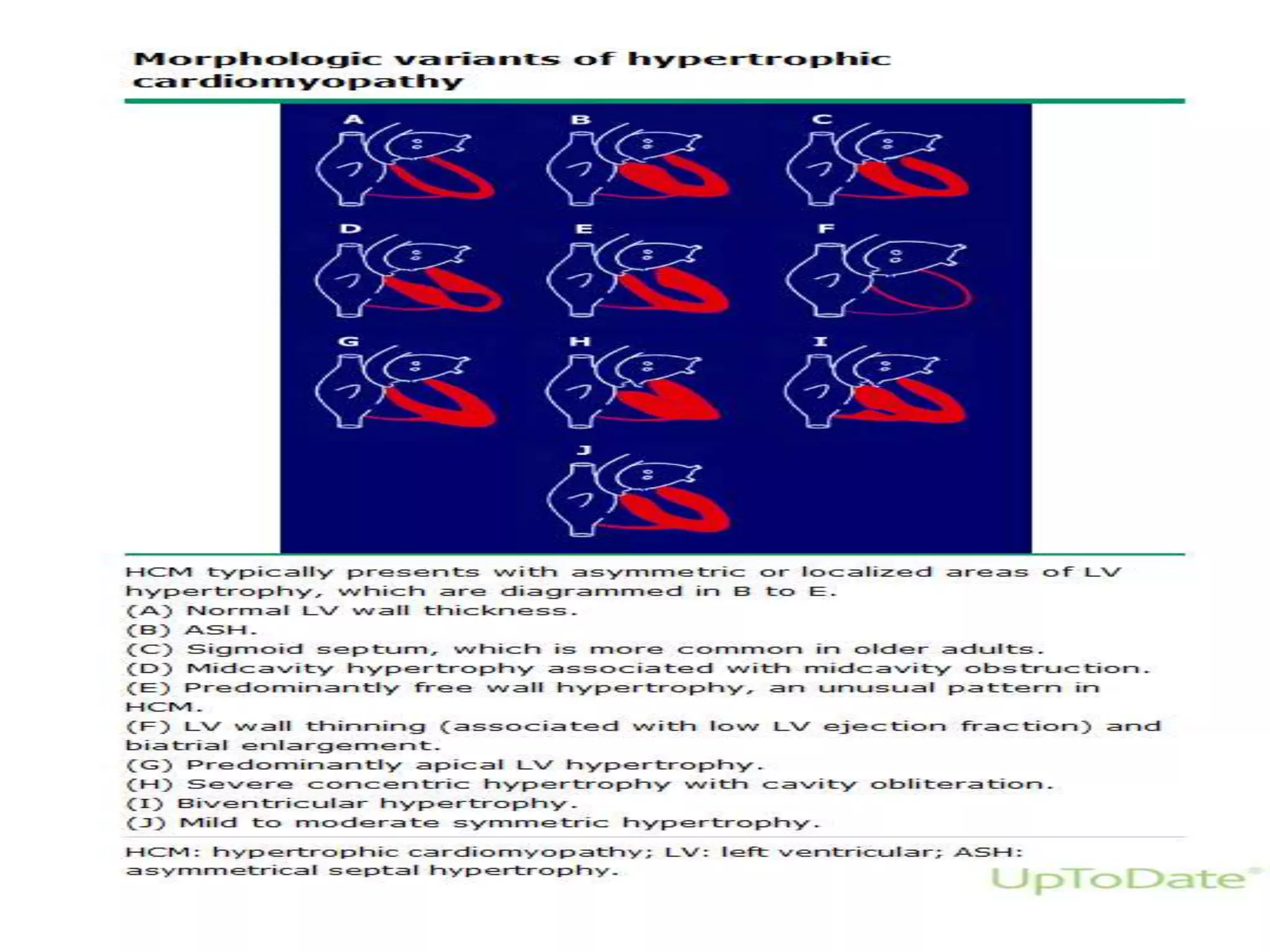 Echo in hypertrophic obstructive cardiomyopathies | PPTX