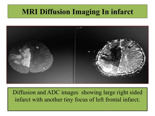rare case of cardioembolic stroke in a child | PPTX | Heart and ...