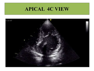 rare case of cardioembolic stroke in a child | PPTX