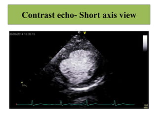 rare case of cardioembolic stroke in a child | PPTX