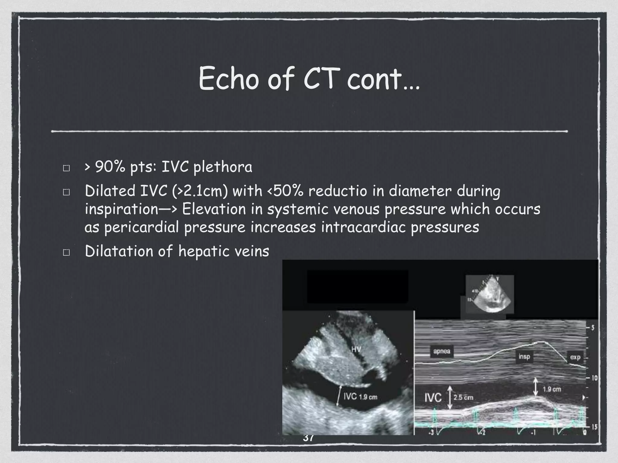 Echo in pericardial diseases | PPTX