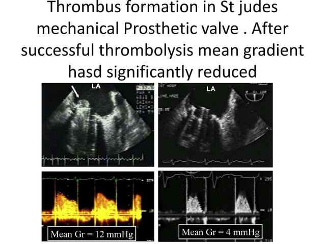 Echo in prosthetic valve evaluation | PPTX