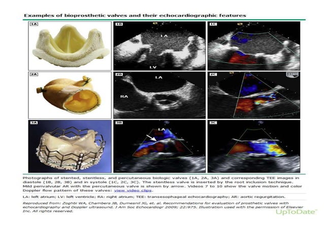 Echo in prosthetic valve evaluation | PPTX