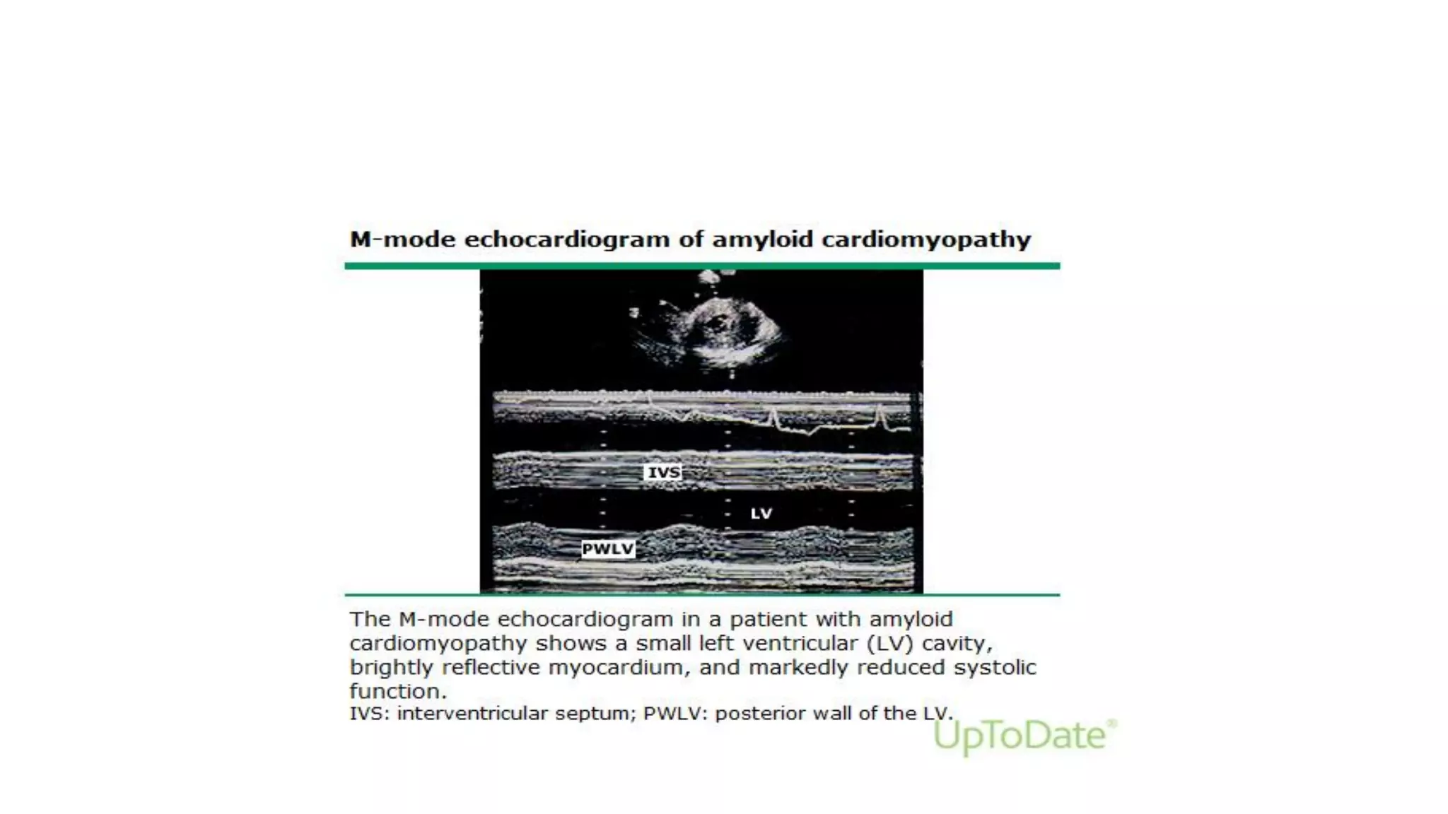 Echo in restrictive cardiomyopathy | PDF Echo in restrictive cardiomyopathy | PDF