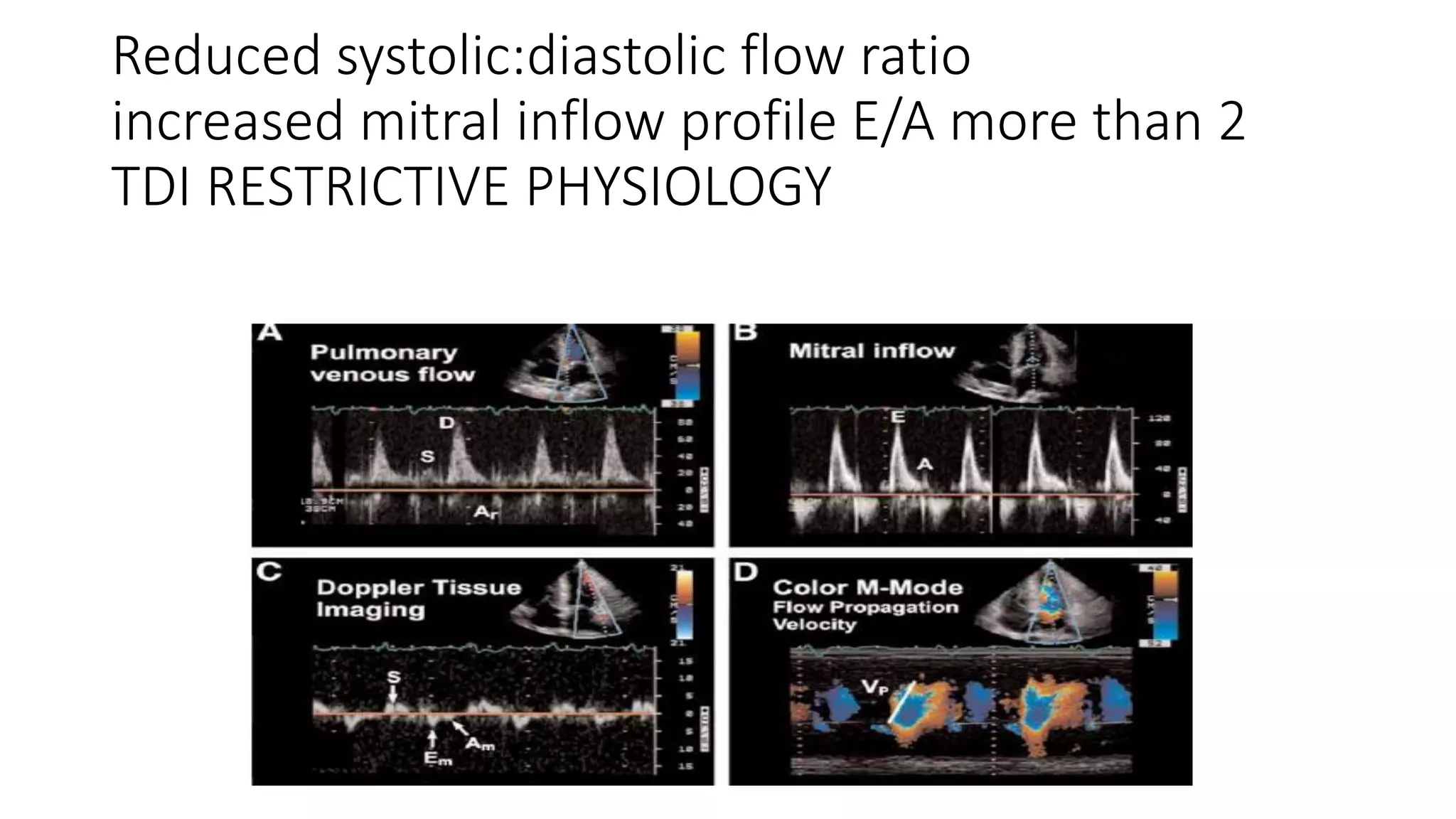 Echo in restrictive cardiomyopathy | PDF Echo in restrictive cardiomyopathy | PDF
