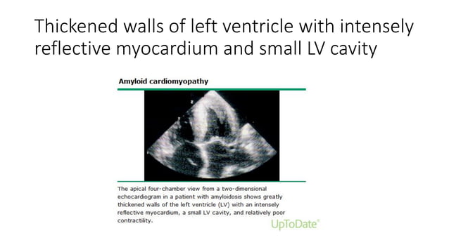Echo in restrictive cardiomyopathy | PDF Echo in restrictive cardiomyopathy | PDF