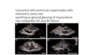 Echo in restrictive cardiomyopathy | PDF