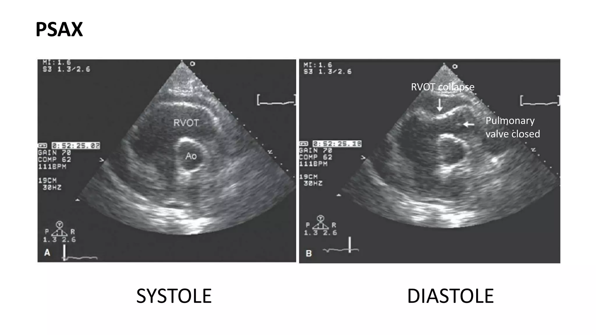 ECHOCARDIOGRAPHY IN CARDIAC TAMPONADE | PPTX