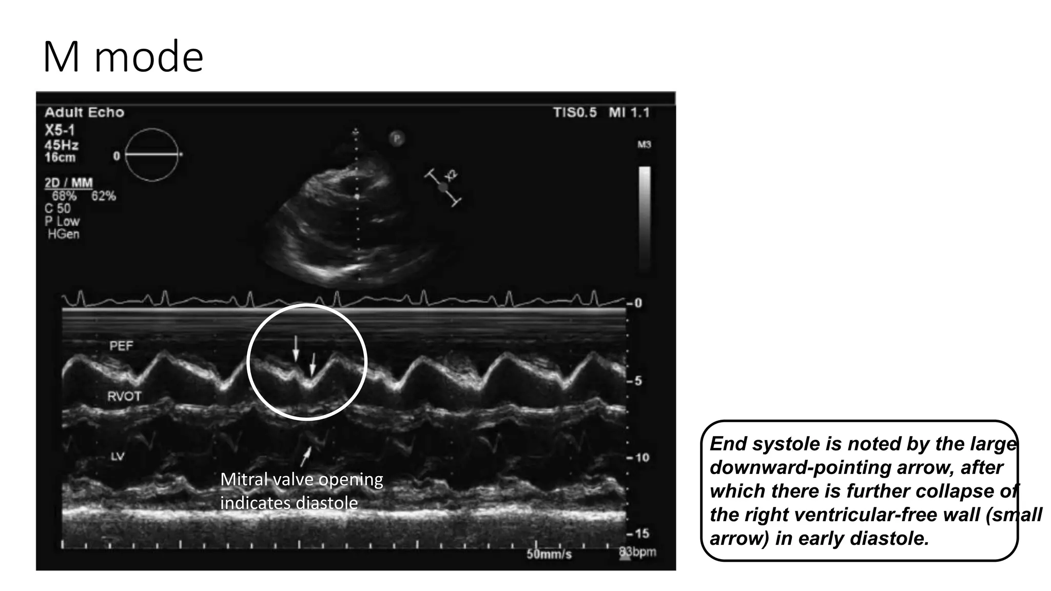 ECHOCARDIOGRAPHY IN CARDIAC TAMPONADE | PPTX