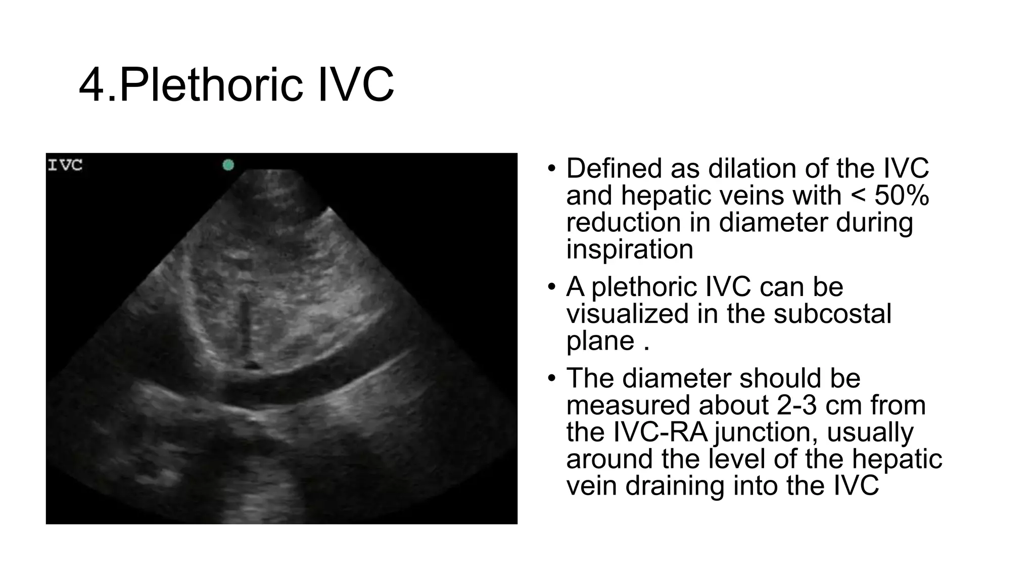 ECHOCARDIOGRAPHY IN CARDIAC TAMPONADE | PPTX
