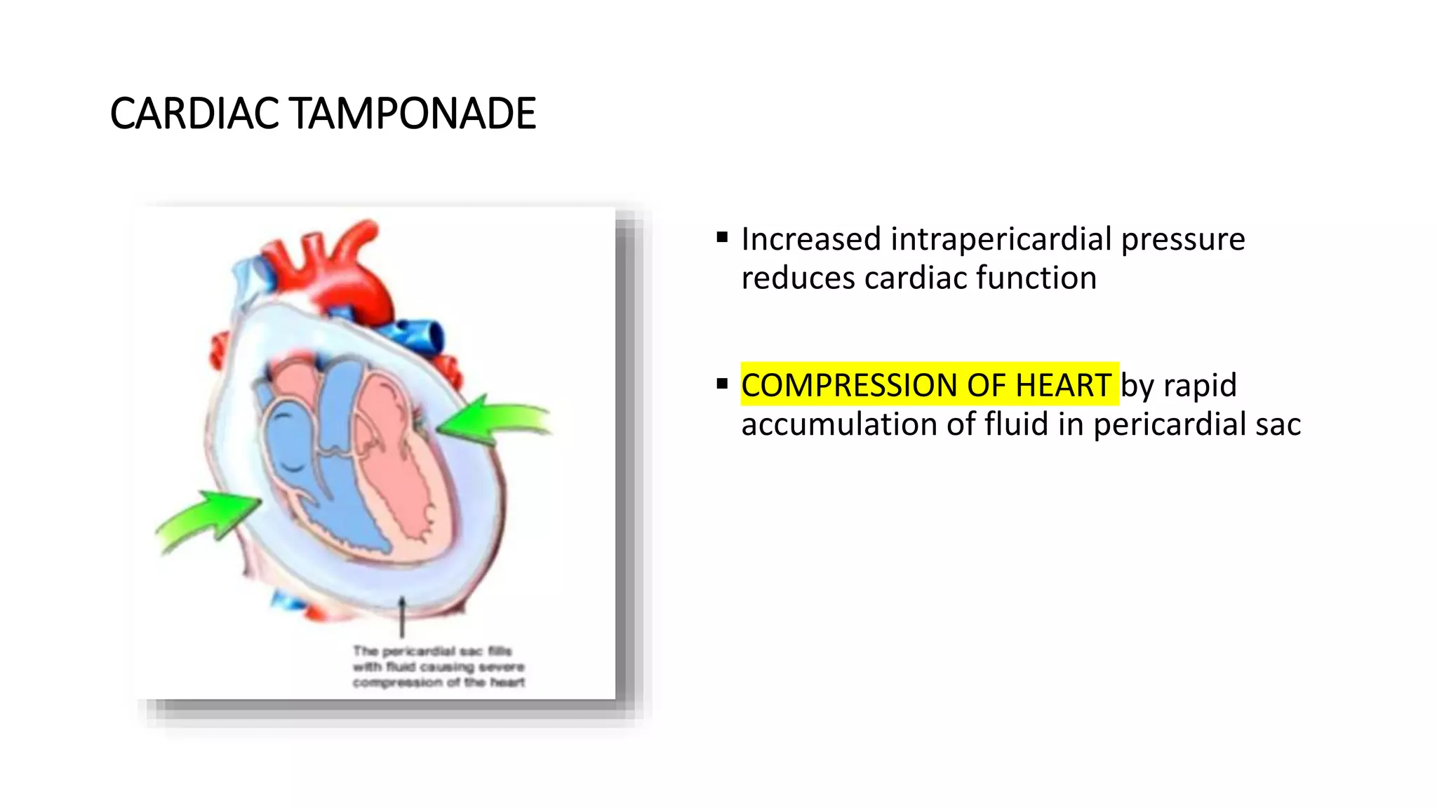 ECHOCARDIOGRAPHY IN CARDIAC TAMPONADE | PPTX