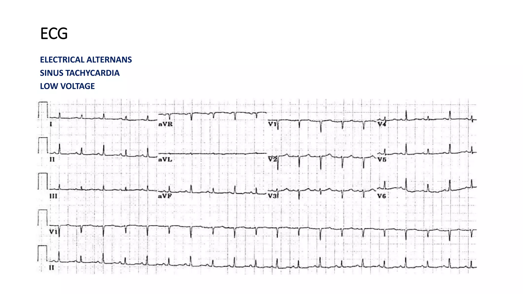 ECHOCARDIOGRAPHY IN CARDIAC TAMPONADE | PPTX