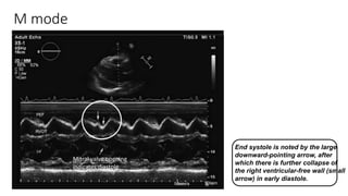 ECHOCARDIOGRAPHY IN CARDIAC TAMPONADE | PPTX