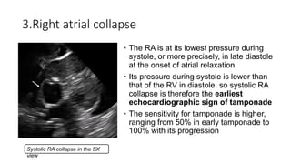 ECHOCARDIOGRAPHY IN CARDIAC TAMPONADE | PPTX