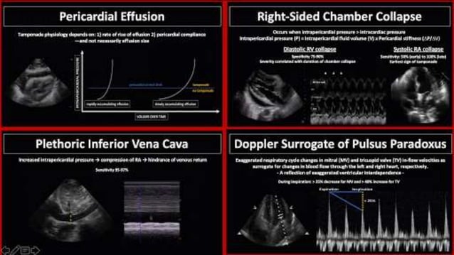 ECHOCARDIOGRAPHY IN CARDIAC TAMPONADE | PPTX