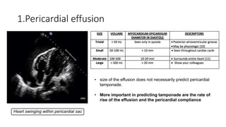 Cardiac Tamponade Echo