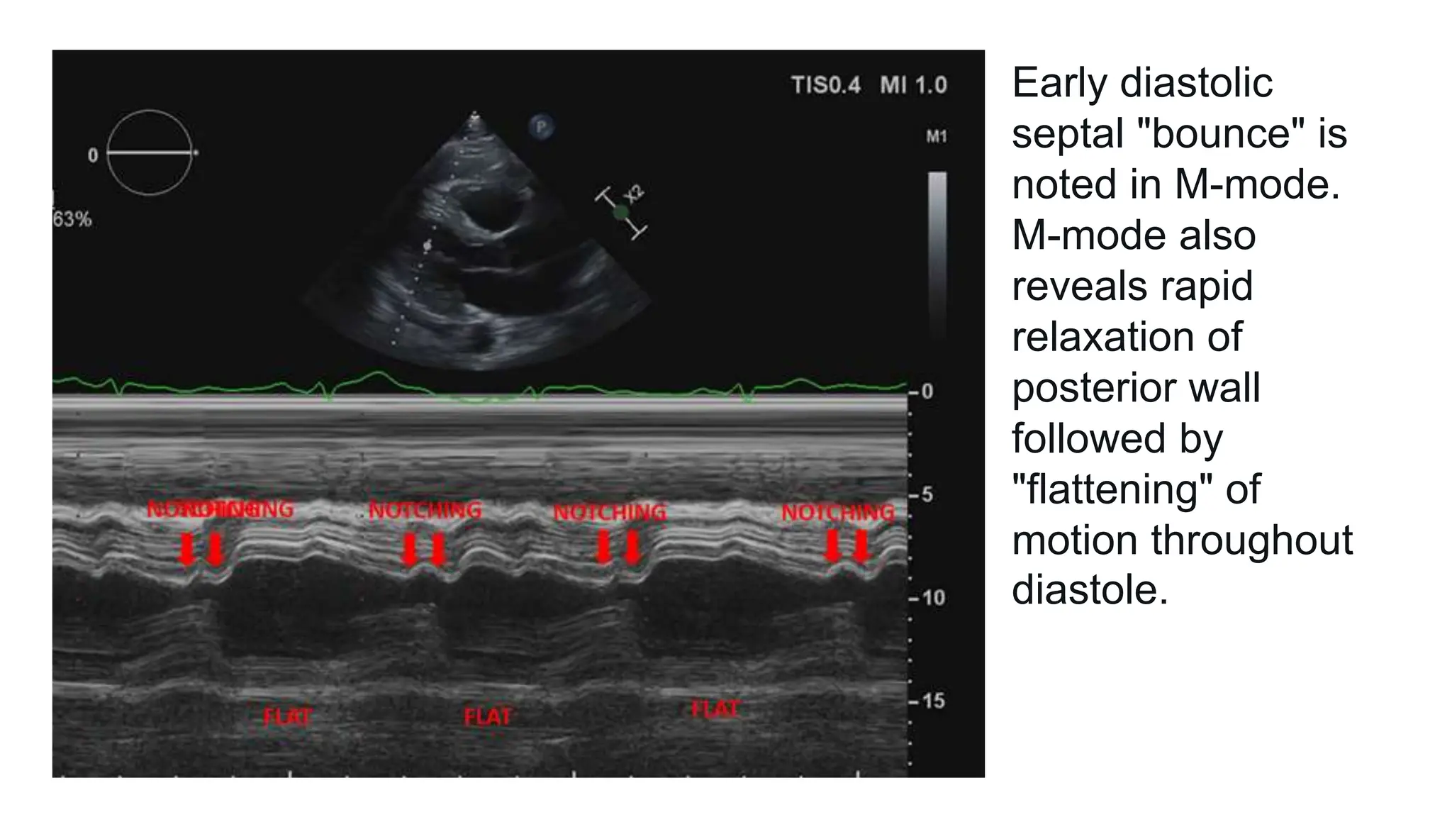 Echocardiography Multiple choice questions | PPTX