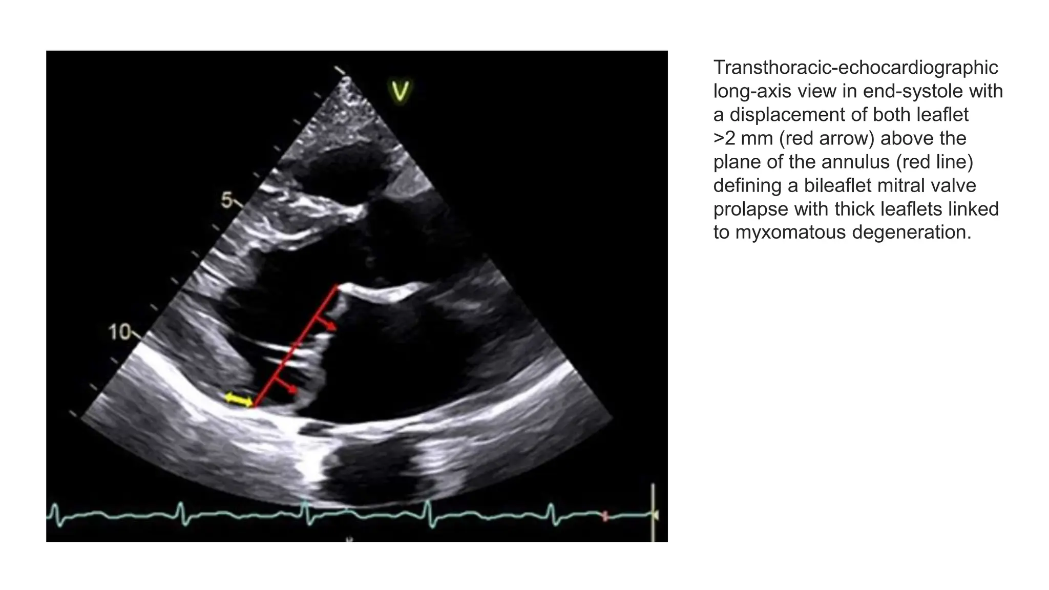 Echocardiography Multiple choice questions | PPTX