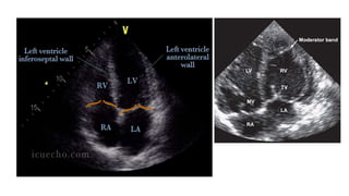 Echocardiography Multiple choice questions | PPTX