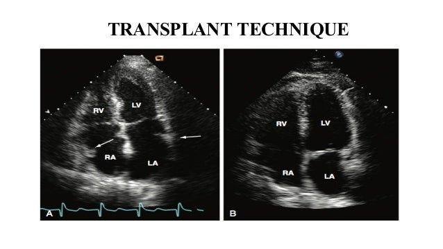 pre and post transplant echo , contrast echo