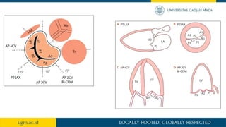 Echo Mitral regurgitasi.pptx