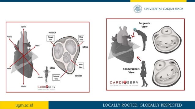 Echo Mitral regurgitasi.pptx