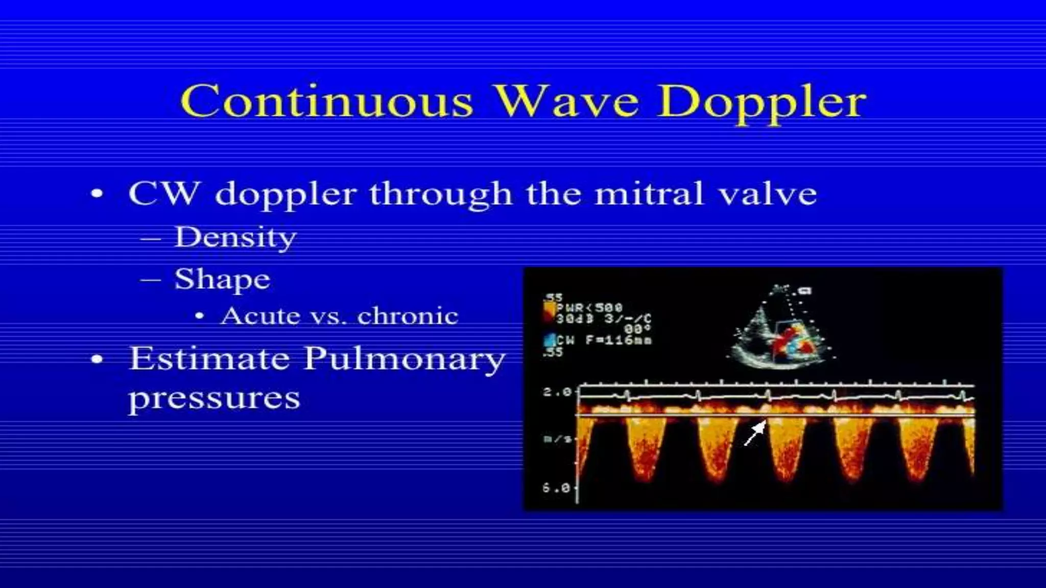 Echo Mitral Regurgitation 1 Pptx