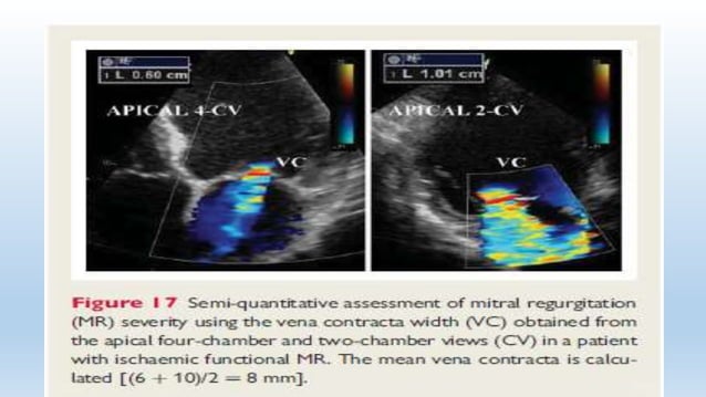 Echo Mitral Regurgitation-1.pptx