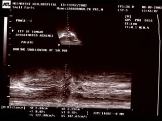 Echomyography of tongue | PPT