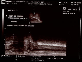 Echomyography of tongue | PPT